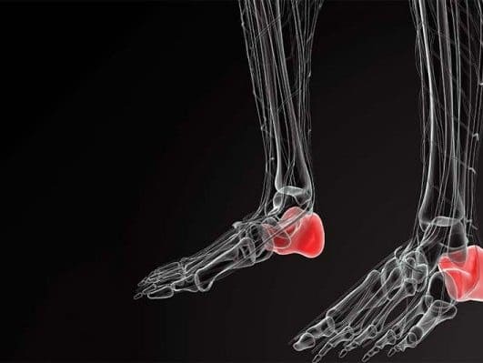 Heel Bone Fracture | The Fresh Foot Centre