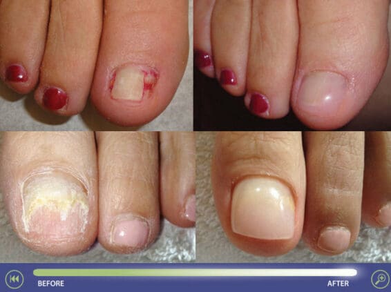 Preventing Corns and Calluses | The Fresh Foot Centre